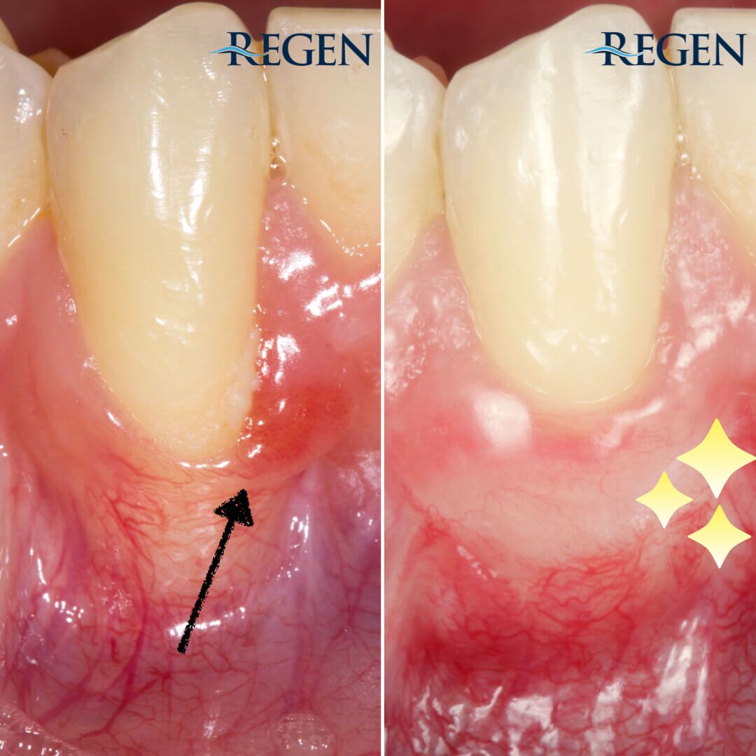 Gum Recession Treatment in Allen, TX | REGEN Periodontics